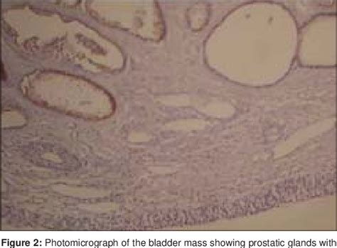 Figure 1 From Ectopic Prostate Presenting As A Mass In Bladder