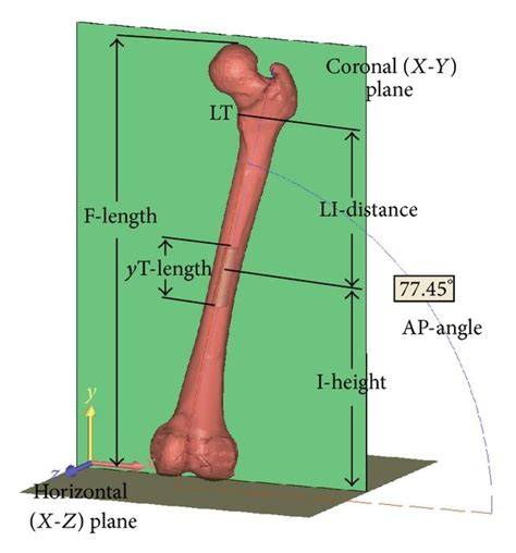 In The Femur Customized Coordinate System The Anatomical Parameters Of