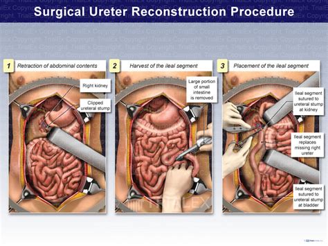 Surgical Ureter Reconstruction Procedure