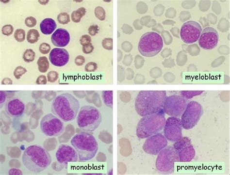 Lymphoblast