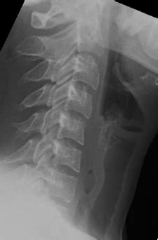 Soft Tissue Neck Radiographs Are They Useful — Taming The Sru
