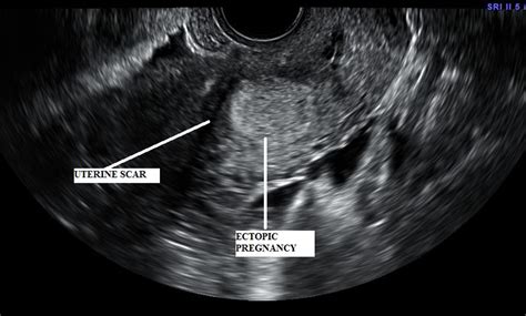 C Section Scar Pregnancy Treatment At Heather Meyers Blog