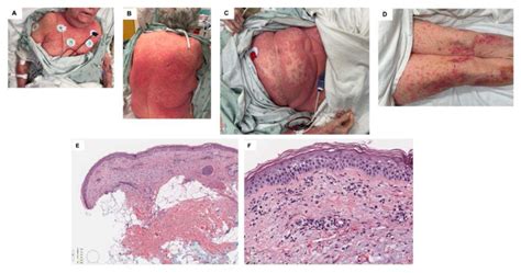 Valacyclovir As Etiology For Drug Reaction With Eosinophilia And