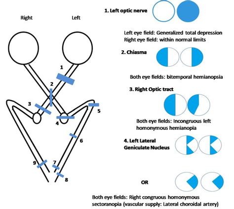 [figure Field Defects Due To Disorders In Visual Pathway Contributed