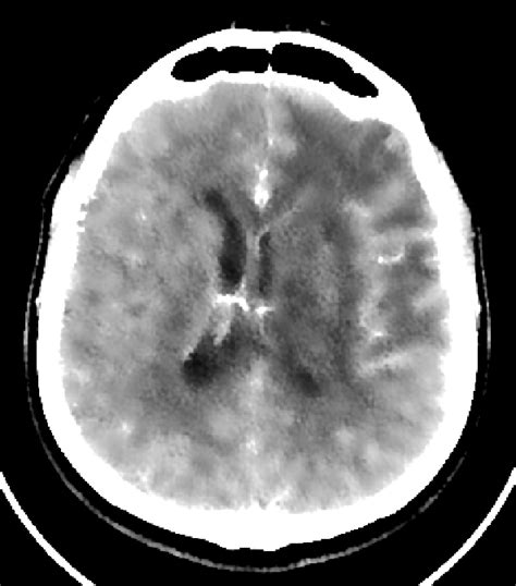 Github Espdev Itkcvbf D D D Cpu Gpu Bilateral Image Filter Based On Itk And Opencv
