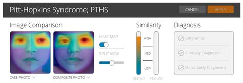Pitt Hopkins Syndrome Clinical And Molecular Findings Of A 5 Year Old