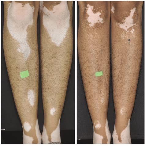 Repigmentation In Vitiligo Lesions Following Integrative Medicine A
