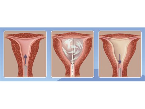 Balloon Ablation Uterus Endometrial Ablation Procedure Purpose