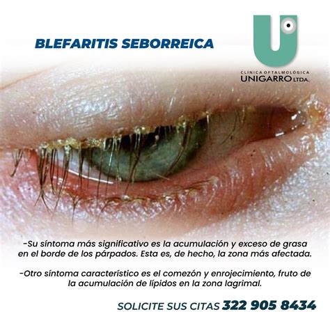 ¿qué Tipos De Blefaritis Clínica Oftalmológica Unigarro Facebook