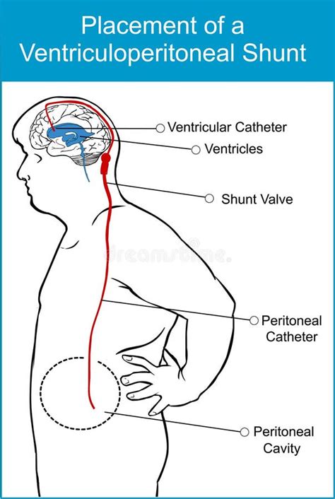 Ventricular Peritoneal Shunt
