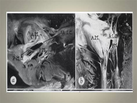 Mitral Valve Scoring Before Bmv Pptx