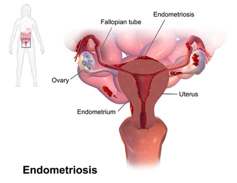 Endometriosis A Women Disease Hubpages
