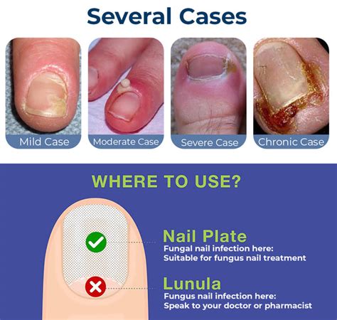 Bacteria Under Nails