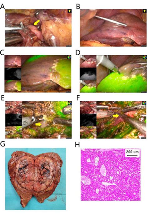 Fluorescent Laparoscopic Central Hepatectomy For Liver Cancer Using