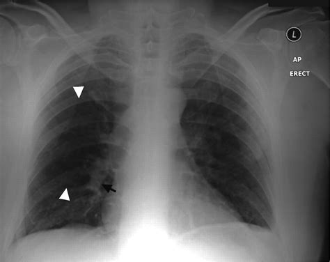 Pulmonary Embolism X Ray