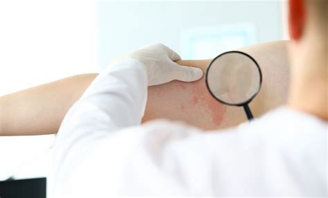 Trichophyton Mentagrophytes Genotype Vii An Emerging Fungus Spread Through Sex Emj