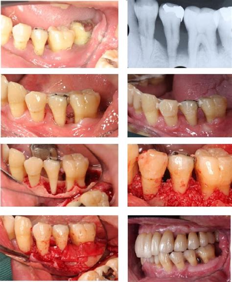 Dental Bone Graft Healing Stages