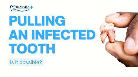 Can You Pull An Infected Tooth Emsekflolcom