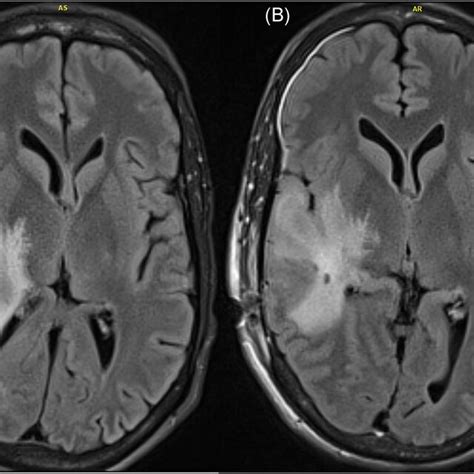 A T2 Flair Of Lobulated Mass In Posterior Superior Aspect Of Right
