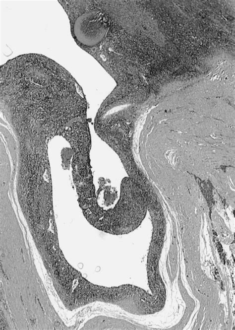 Hemangiopericytic Growth Pattern In Monophasic Synovial Sarcoma Showing