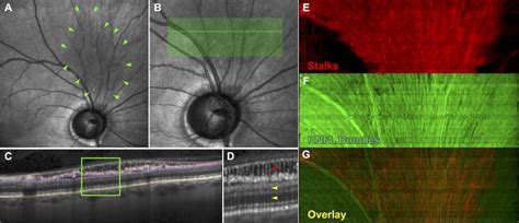 Peripapillary Retinoschisis In Glaucoma Association With Progression
