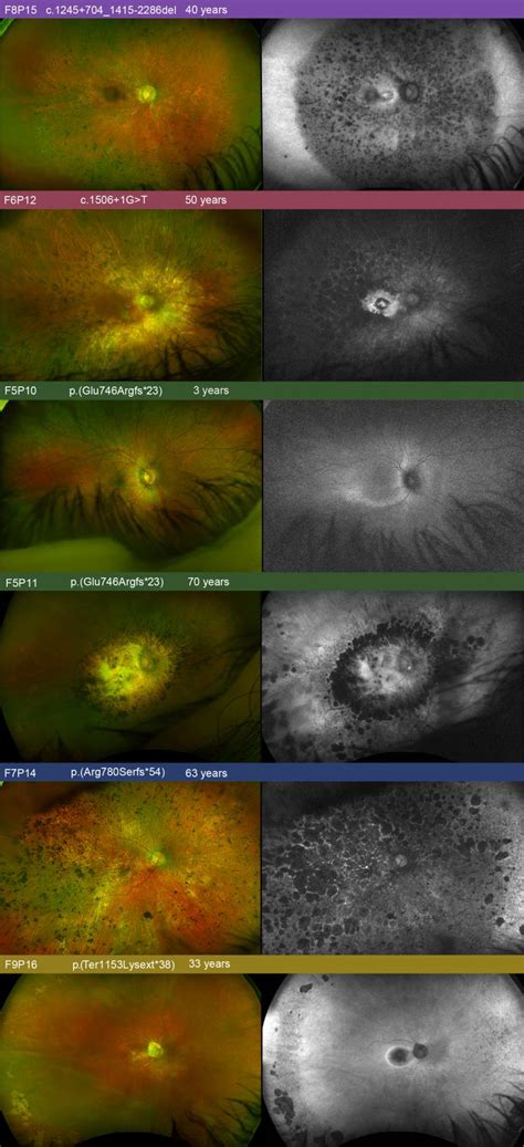 Wide Field Optos Color Left Column And Faf Right Column Fundus