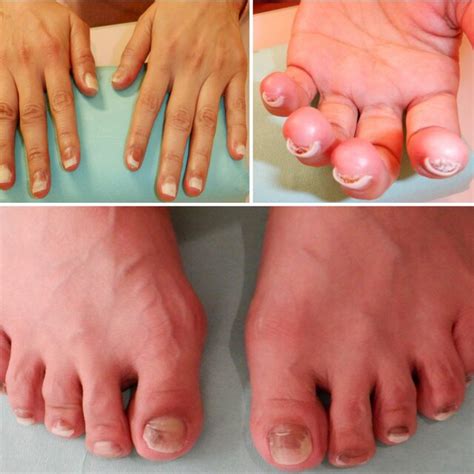 Nail Disorders By Pemigatinib Download Scientific Diagram