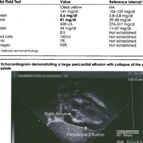 Pericardial Fluid Analysis Download Table
