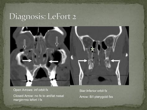 Lefort 2 Fracture