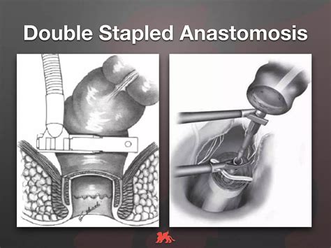 Evolution And New Trends Of Restoration Following Proctocolectomy Pdf