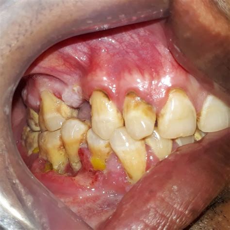 Clinical Picture Showing Severely Inflamed Gingiva With Necrosis Of