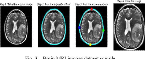Deep Convolutional Neural Networks Model Based Brain Tumor Detection In Brain Mri Images Paper