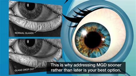 Dry Eye And Mgd Patient Education Video Youtube