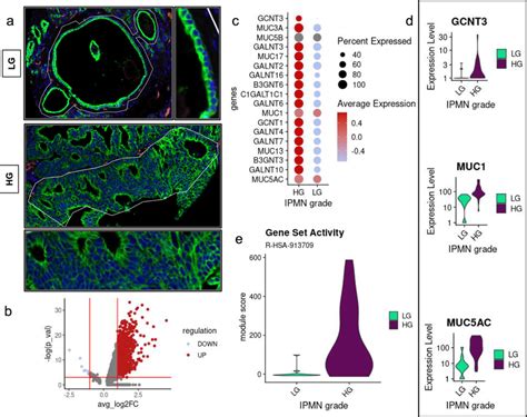 Geomx Spatial Transcriptomics Analysis A Low Grade Lg And Download Scientific Diagram