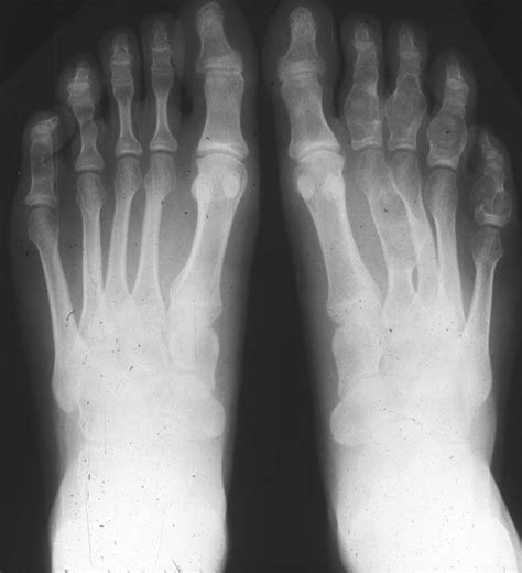 Enchondroma Foot Doctor Southlake Keller Flower Mound North