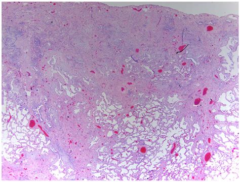 Figure 1 From Pathogenesis Of Idiopathic Pulmonary Fibrosis Semantic