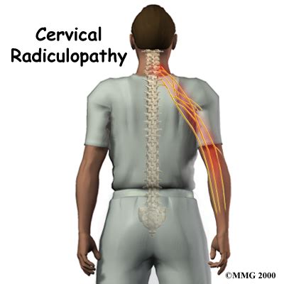 Physical Therapy In Middleton For Cervical Radiculopathy
