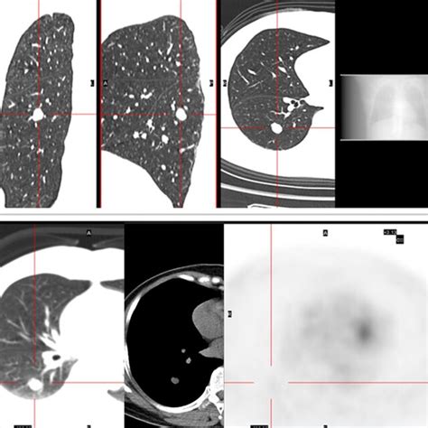 A Kind Of Round Nodular Opacity Was Observed In The Dorsal Segment Of