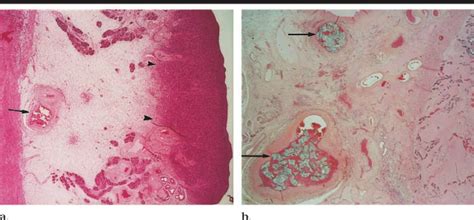 Results Of Embolization Performed With 150 250 ␮ M Pva Particles In