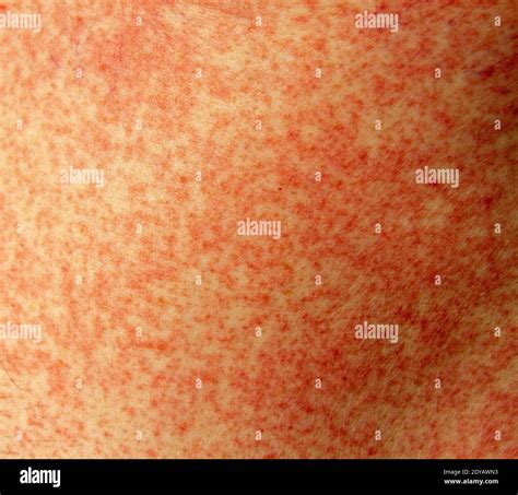 An Allergic Reaction Side Effect To Penicillin Amoxicillin On The