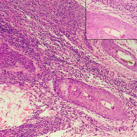 Close Up View Of Skin Lesions Showing Erythematous Edematous Papules Download Scientific