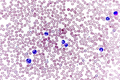 Neutrophilia An Overview ScienceDirect Topics 54 OFF
