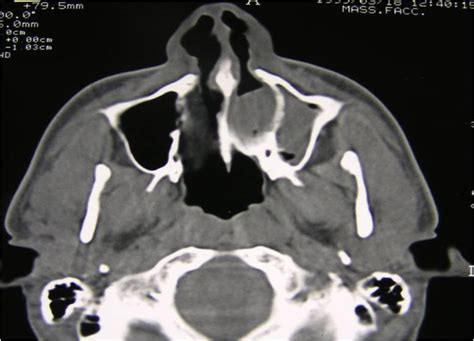 Surgical Treatment Of Choanal Atresia With Transnasal Endoscopic