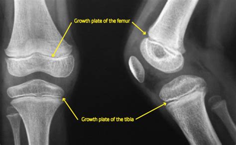 Where Is The Growth Plate Growth Plate Fractures Xexif