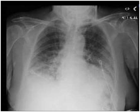 Chest Radiograph On Admission Showing Basilar Opacities Blunting Of Download Scientific