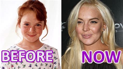 Lindsay Lohan Lips Before And After