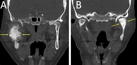 Focal Sclerosing Osteomyelitis