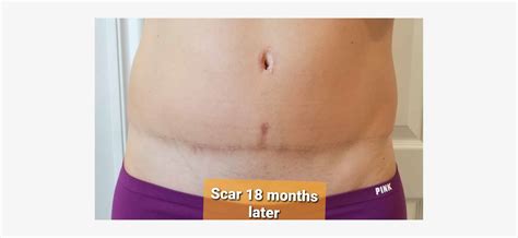 What Real Tummy Tuck Scars Look Like On 12 Patients Realself News