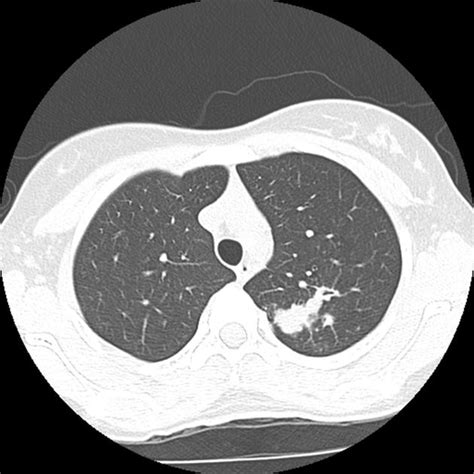 Pulmonary Manifestations Of Tuberculosis Pacs