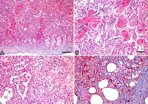 Interstitial Lung Disease Histology